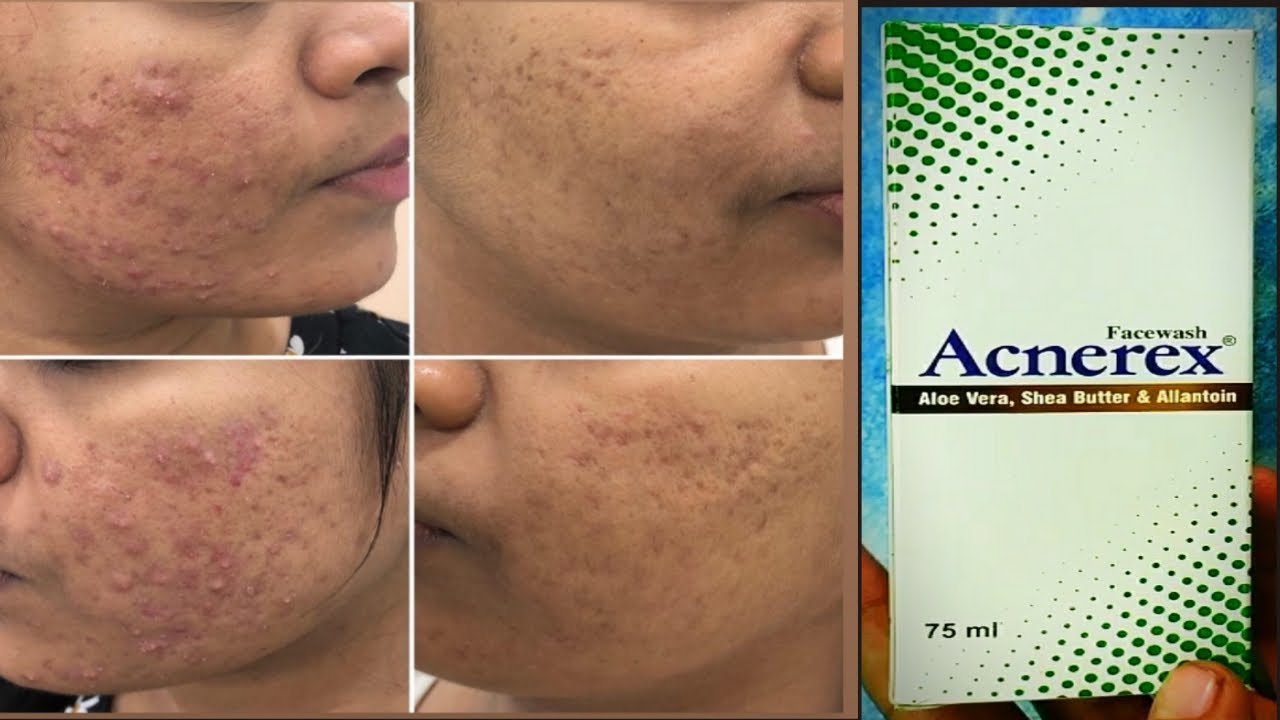 Acnerex Face Wash For Glowing Skin | Acnerex Face Wash pimple Acnerex ...