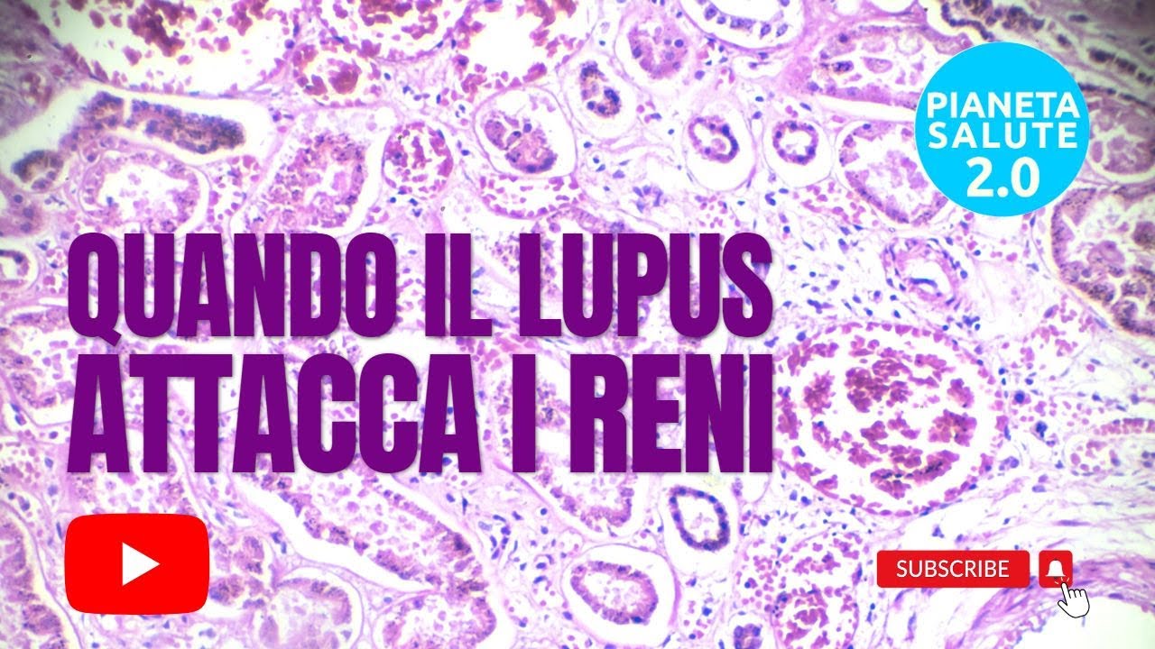 Belimumab primo anticorpo monoclonale in formulazione sottocute per ...