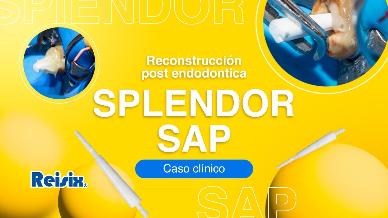 Caso clínico: Reconstrucción Post Endodontica con Splendor SAP de Dra ...