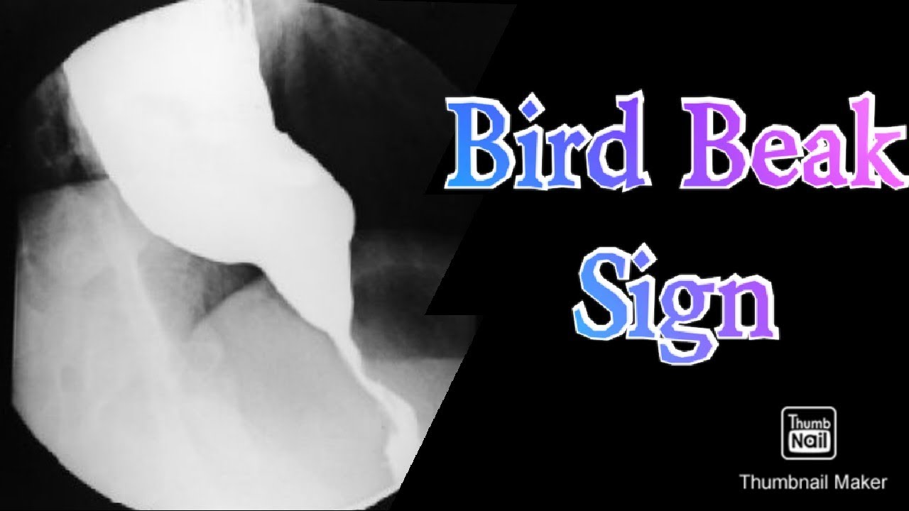 Achalasia Cardia , Bird Beak Sign 👍😀 - YouTube