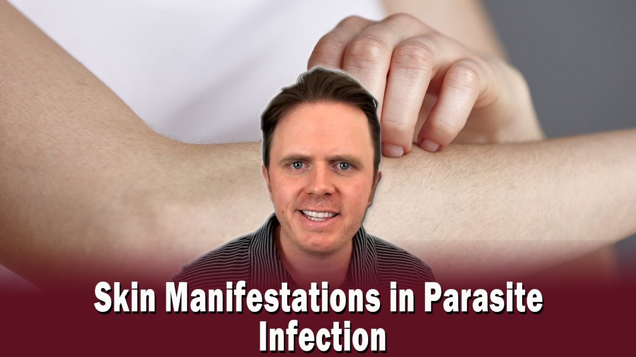 Skin Manifestations in Parasite Infection - YouTube