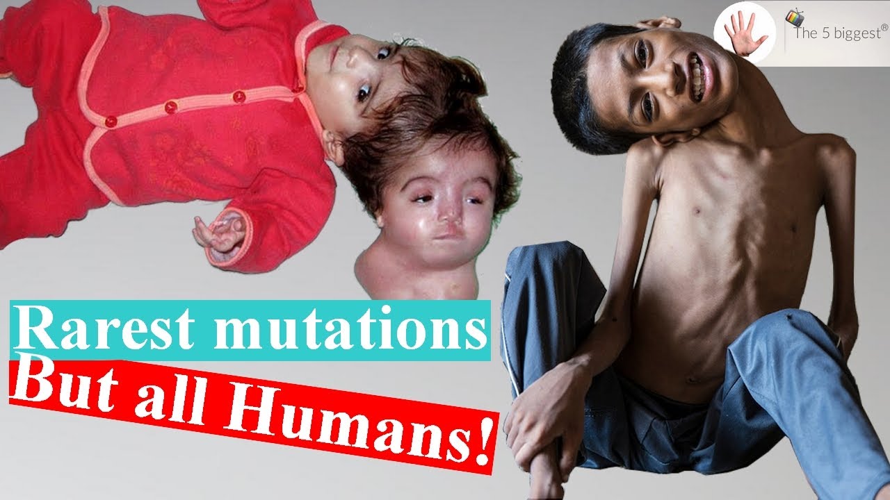 Rarest Disease Touching Stories Of People With Rare Mutations ~ Body