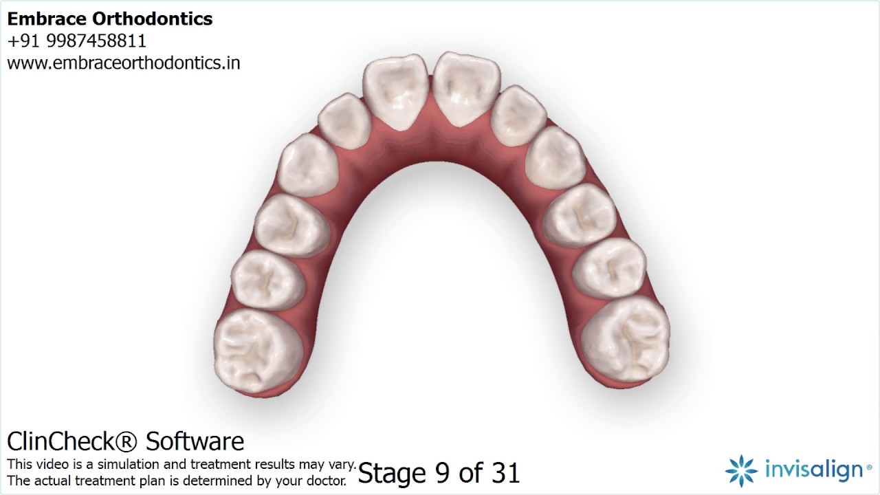 This is how we close gaps with Invisalign!! - Teeth movement with ...