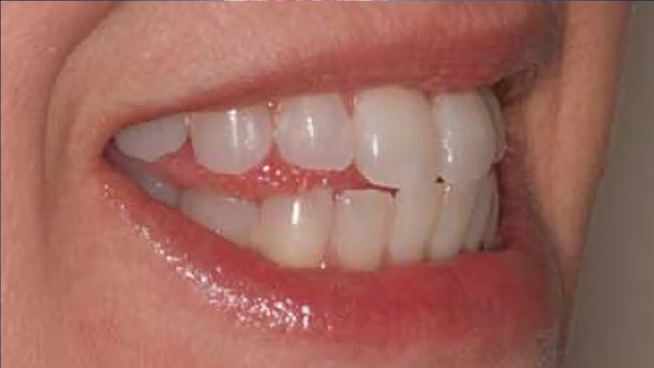 How To Get Rid Of A Lisp From A Retainer Youtube