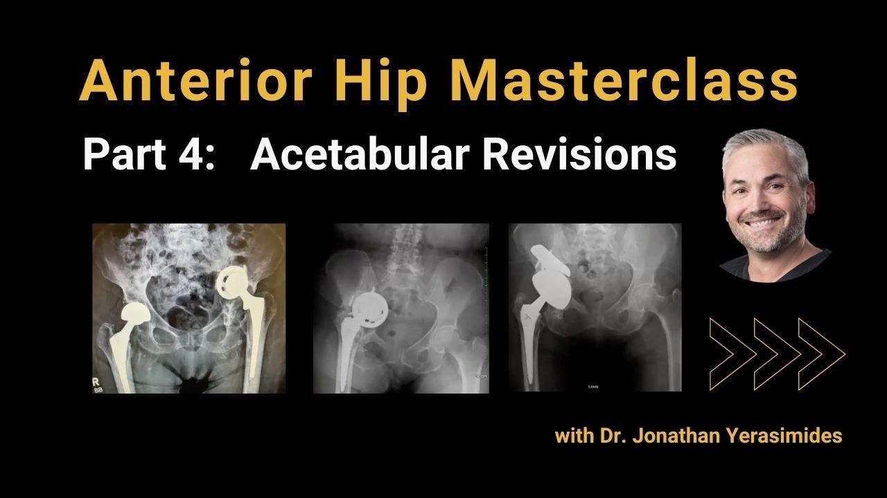 Acetabular Revision Through the Anterior Approach - YouTube
