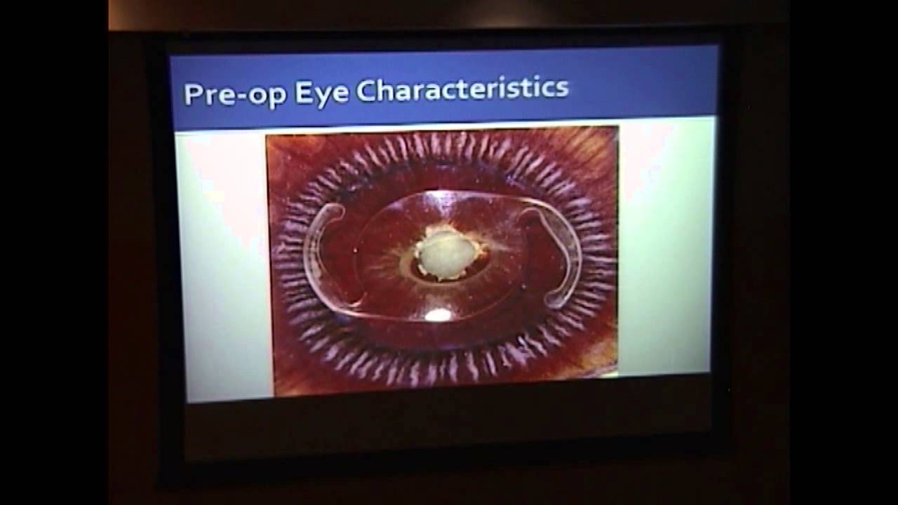 Assessment of a New Hydrophilic Acrylic Supplementary IOL for Sulcus ...