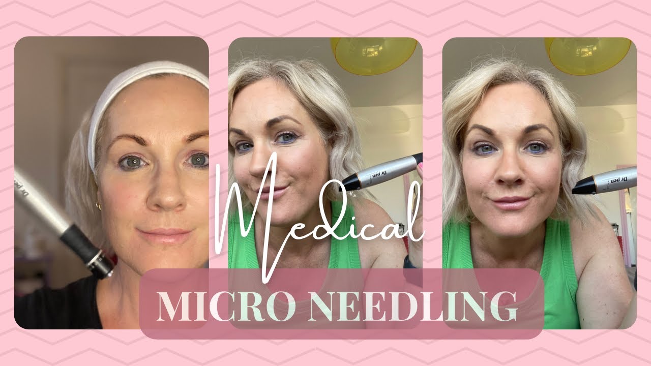 Micro needling at home (face, neck and hands) - YouTube