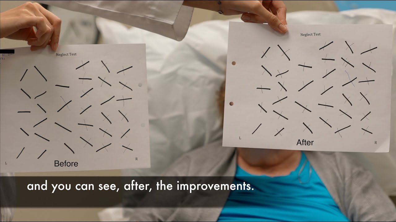 Improvement in left-side neglect and pain minutes after treatment by ...