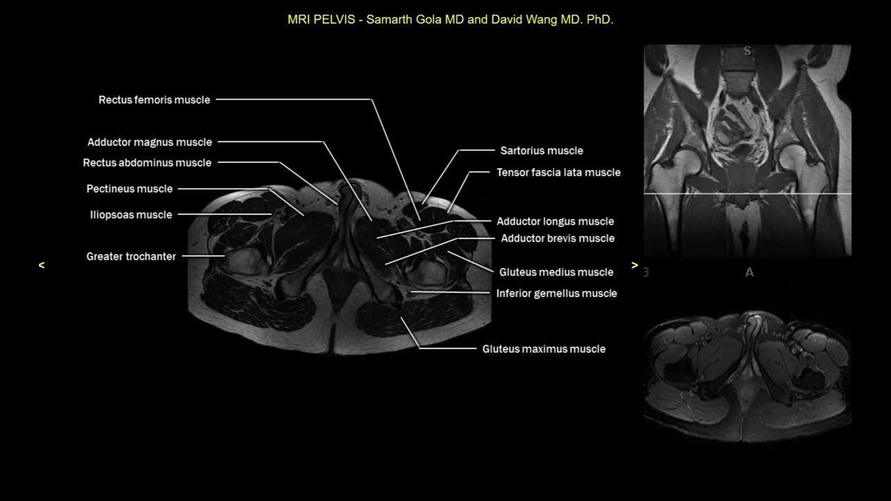 Mri Anatomy Atlas at Annabelle Raggatt blog
