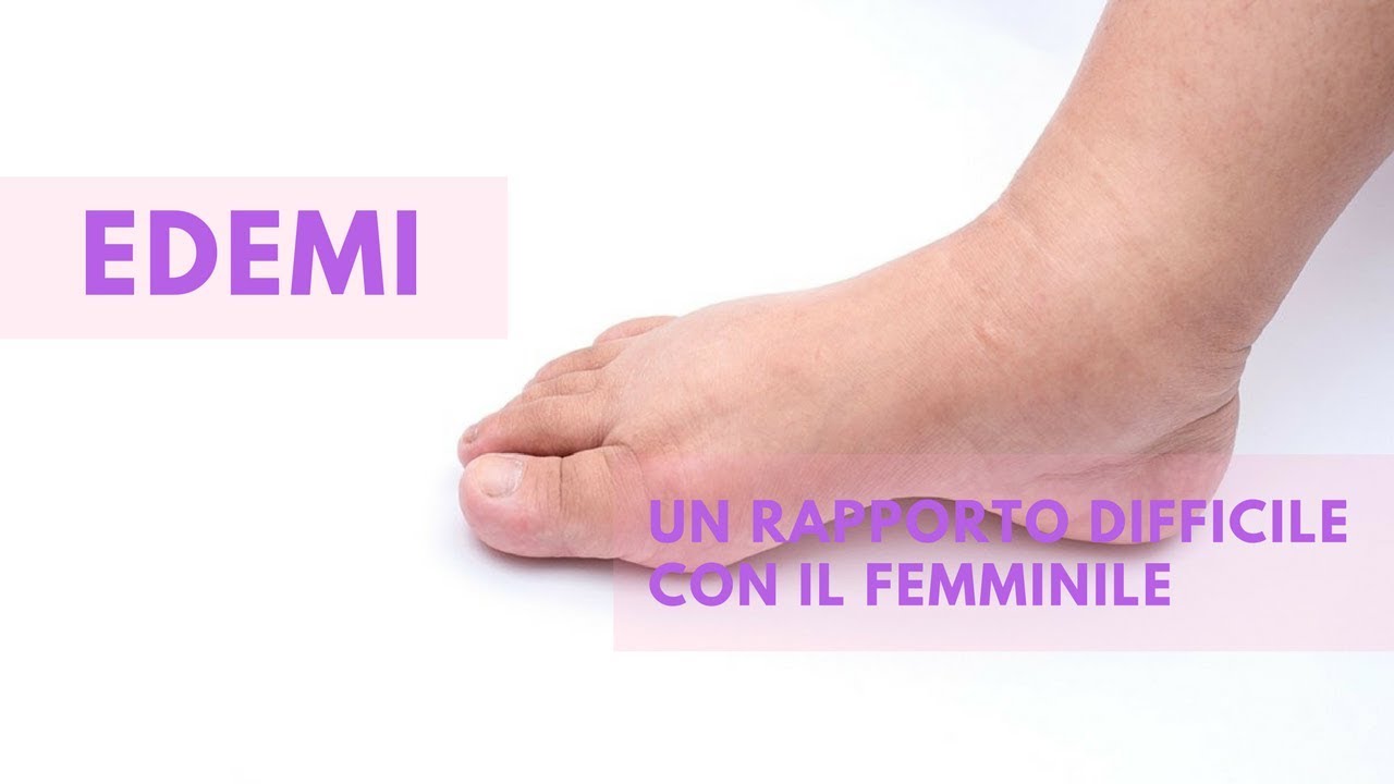 Edemi | Pronto Soccorso Naturale - YouTube