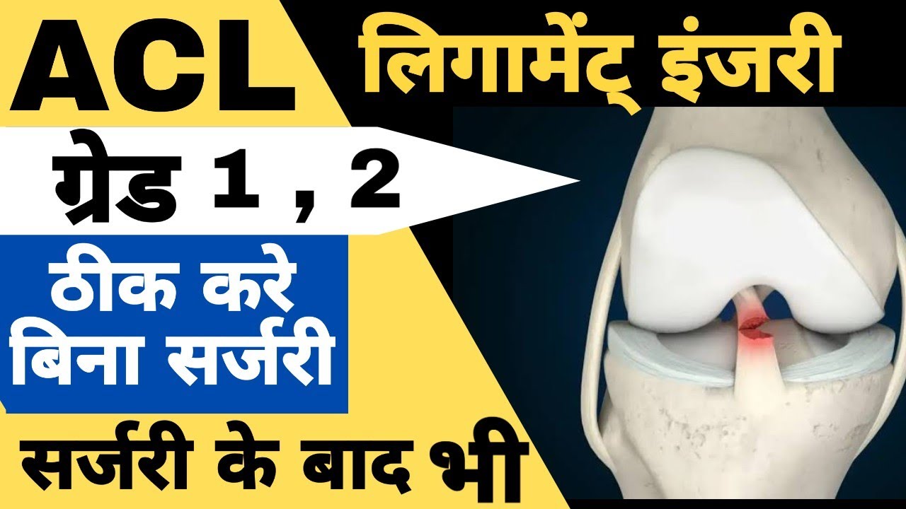 ACL लिगामेंट् इंजरी ग्रेड 1और 2 का बिना सर्जरी ईलाज। ACL ligament ...