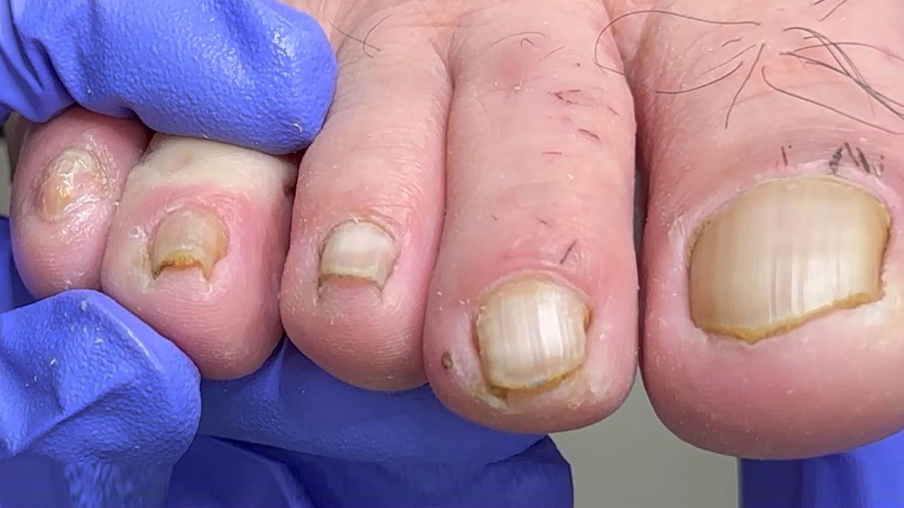 All 5 toenails are embedded, the whole process of trimming!【Doctor Liu ...