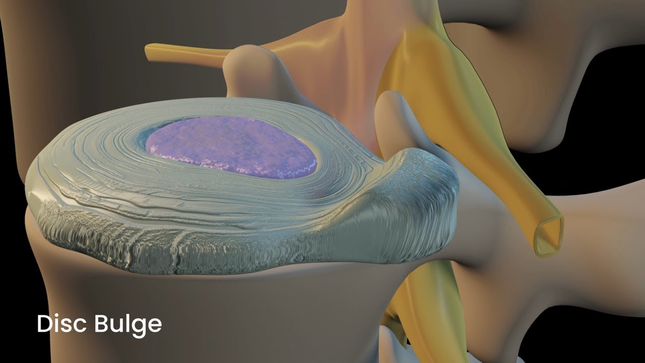 Do All Disc Bulges Need Surgery? Dr. Atmaranjan explains when you need ...
