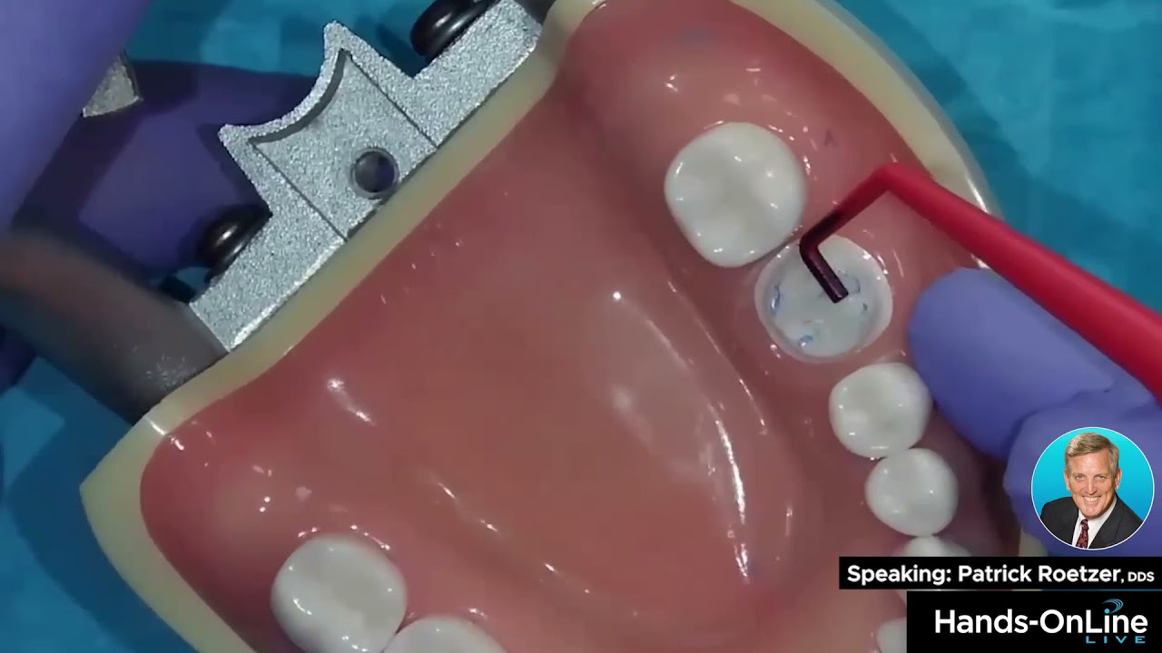 PrepSure Crown Prep Guide with Patrick Roetzer, DDS - YouTube