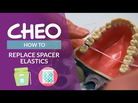 What Are Spacers For Teeth: A Detailed Guide