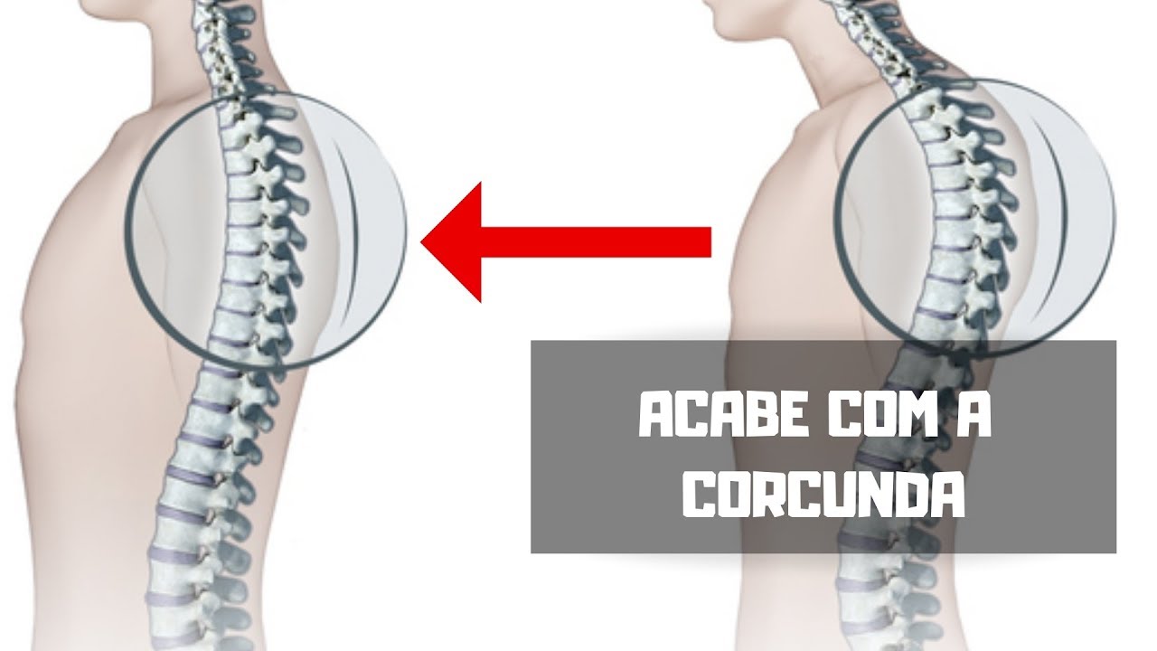 HIPERCIFOSE - COMO CORRIGIR? ACABE A CORCUNDA! - YouTube