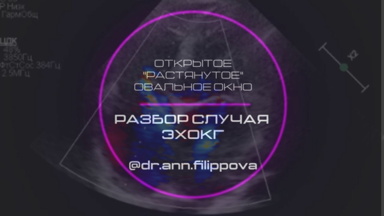 "РАСТЯНУТОЕ" ОТКРЫТОЕ ОВАЛЬНОЕ ОКНО. Эхокардиография. STRETCHED PFO ...