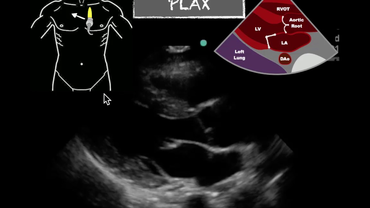 POCUS PLAX Normal EF - YouTube