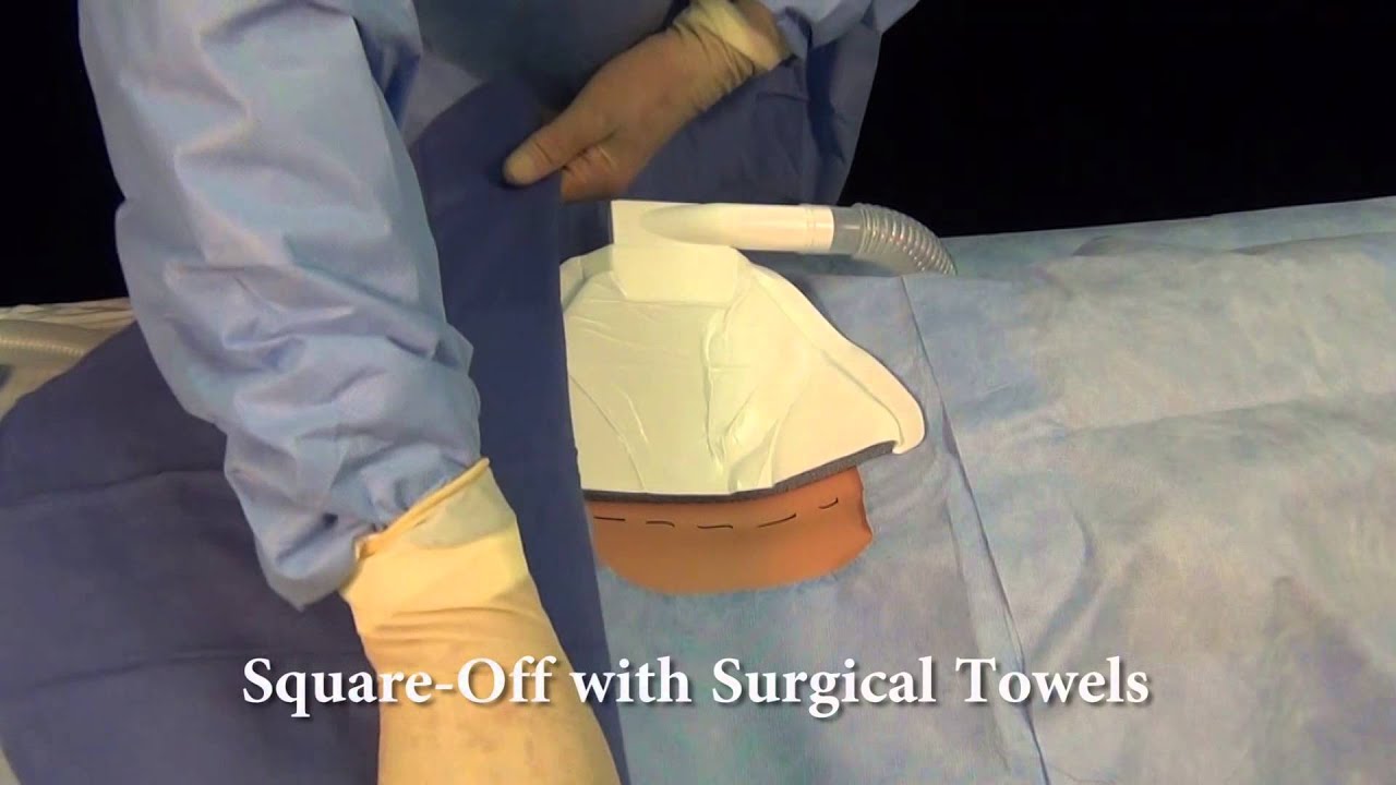 miniSQUAIR Placement - Midline Back Incision - YouTube