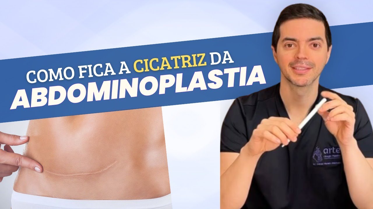 Cicatriz de Abdominoplastia: tudo que você precisa saber - YouTube
