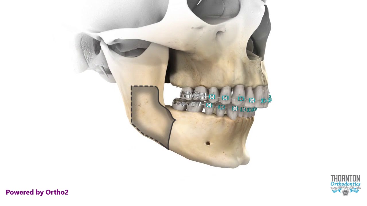 BSSO Mandibular Advancement - YouTube