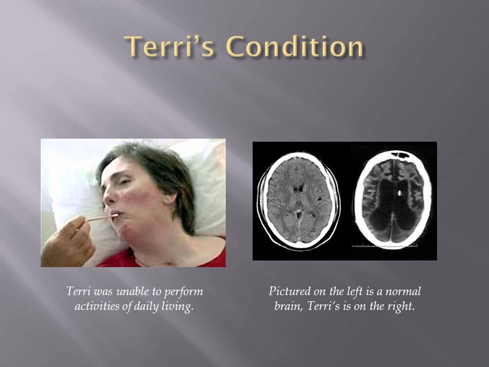 Terri Schiavo Brain
