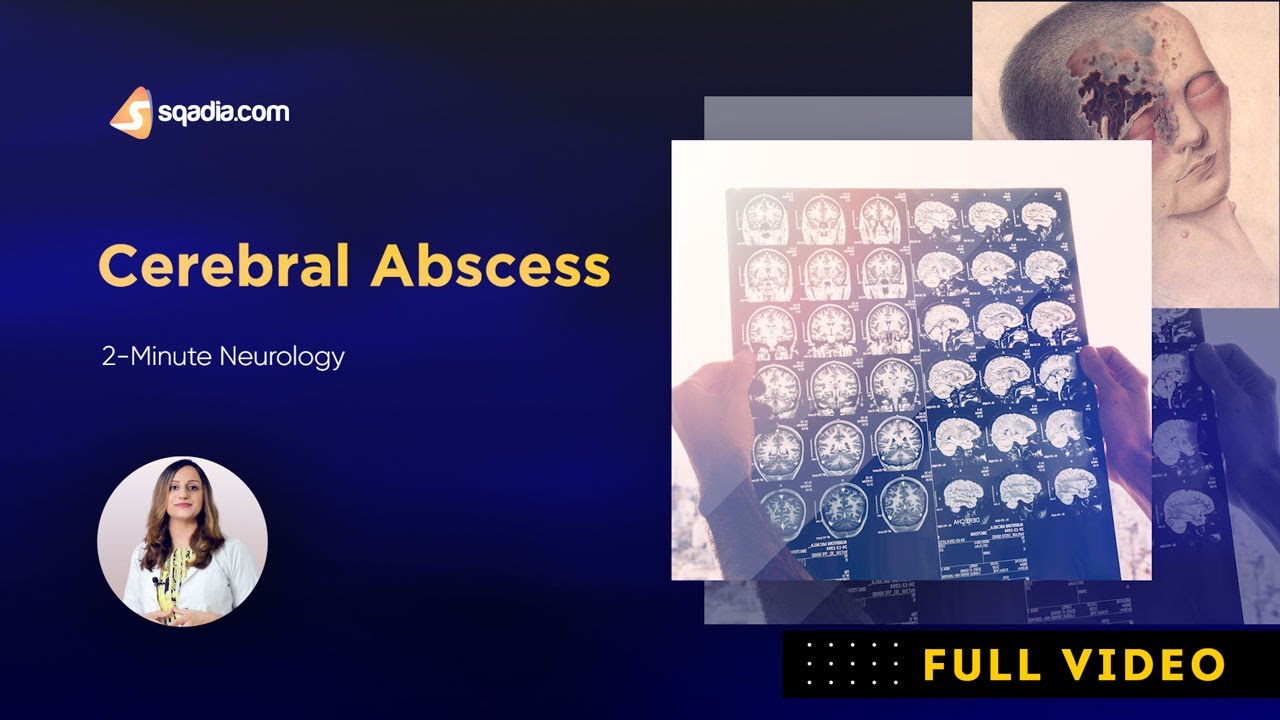 Cerebral Abscess Pathophysiology | 2-Minute Neurology Video | V ...
