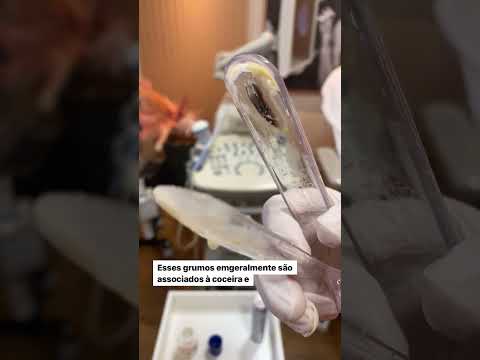 Corrimento com grumos? #ginecologista #candidiase #shorts