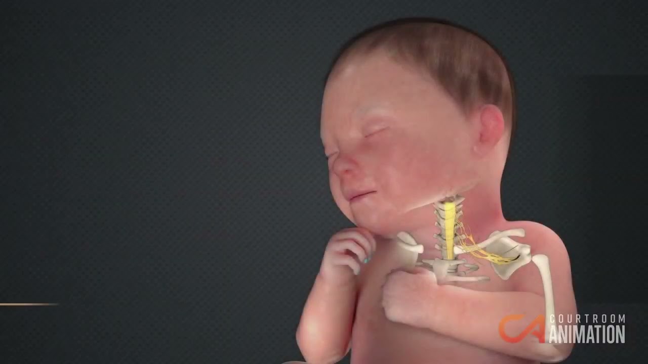 Birth Injury: Medical Malpractice Animation - YouTube