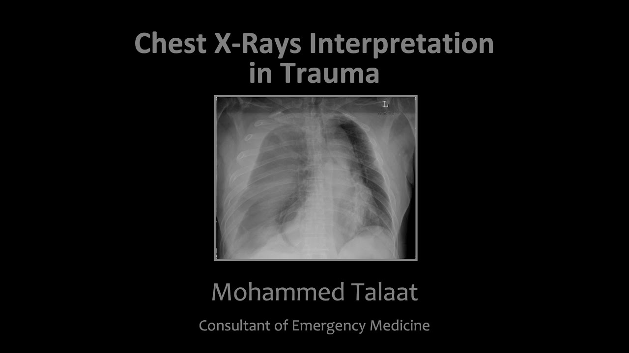 Chest X Rays Interpretation in Trauma - YouTube