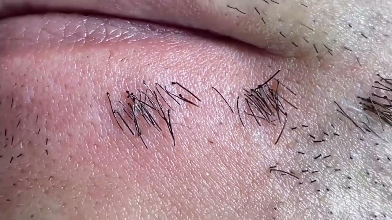 【plucking Facial Hair】ずっと見ていられる鬼滅のヒゲ抜き 2020 6 26(口元ヒゲ全部抜き)【pull Out The
