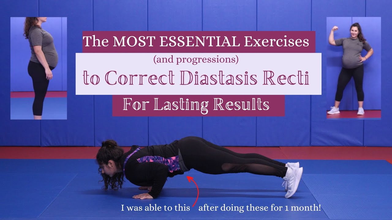 The MOST ESSENTIAL Exercises to Correct Diastasis Recti | Lasting ...