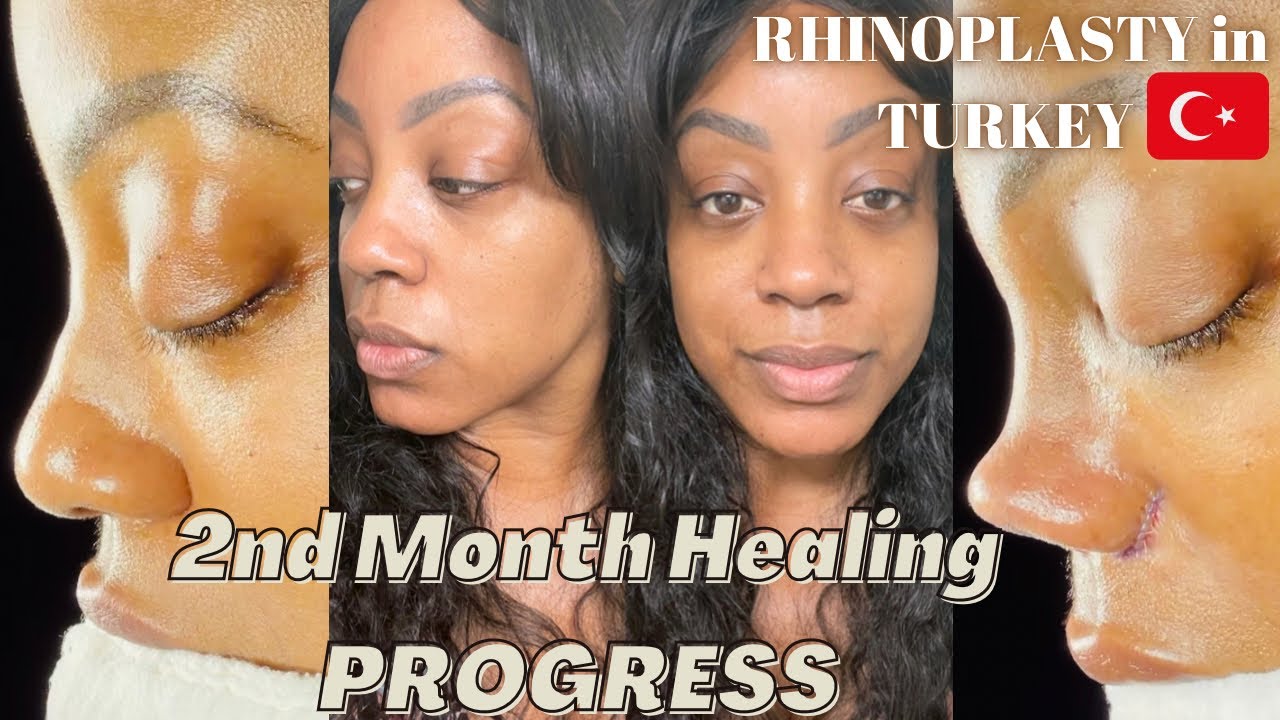 ETHNIC RHINOPLASTY in TURKEY 🇹🇷 | 2nd Month Healing Progress | NO ...