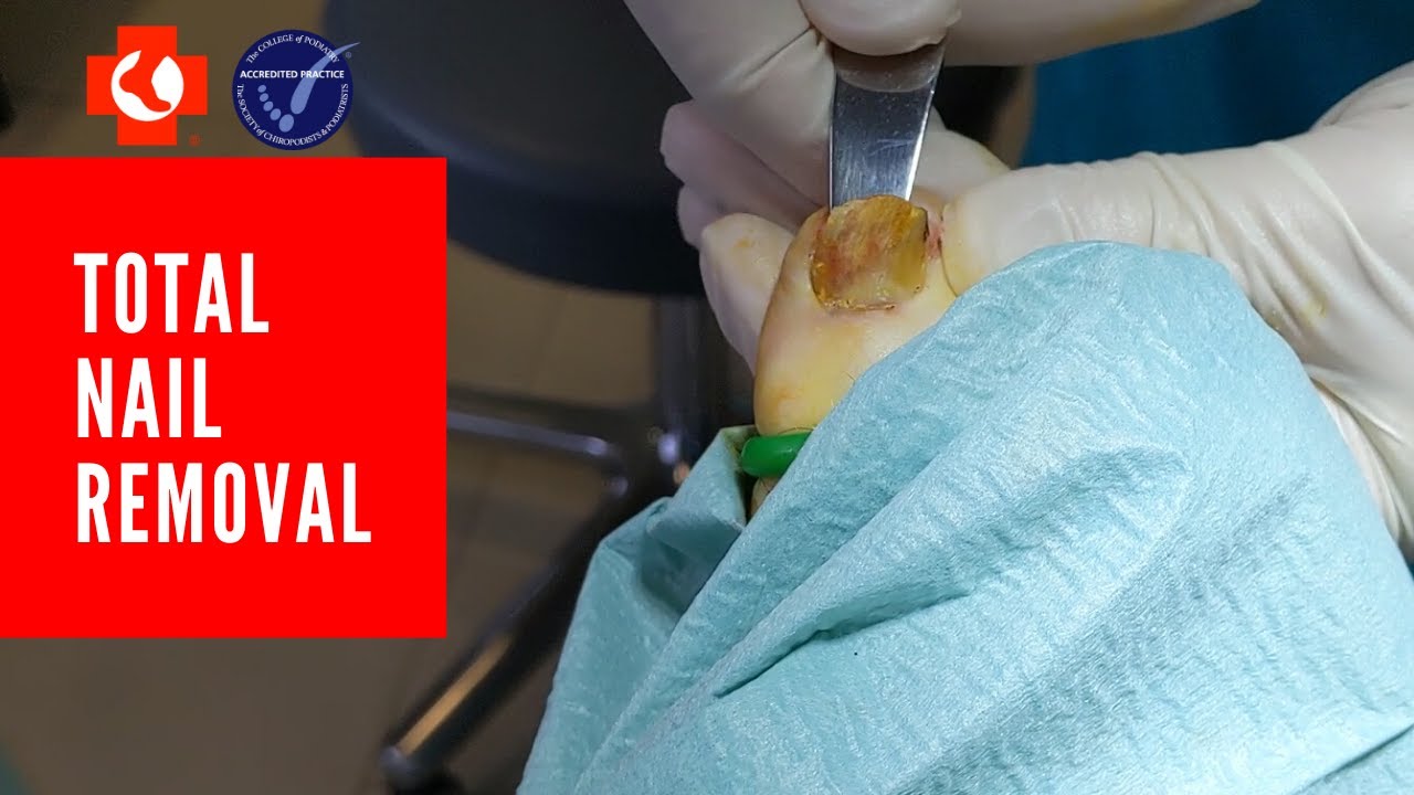 WHOLE NAIL REMOVAL - YouTube