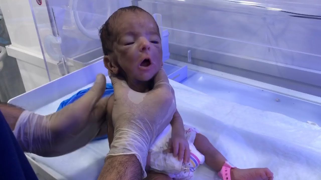 Baby condition improved 🤍From NG feeding to oral feeding — a big ...