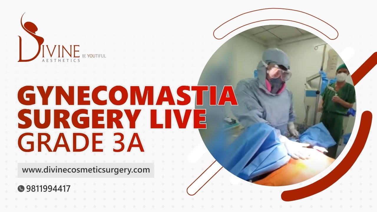 Gynecomastia Surgery Grade 3A Live - YouTube