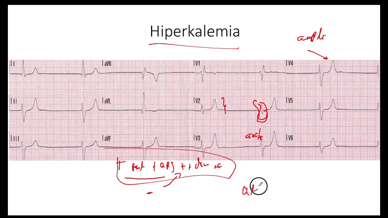 Onda T Apiculada Hipercalemia - RETOEDU