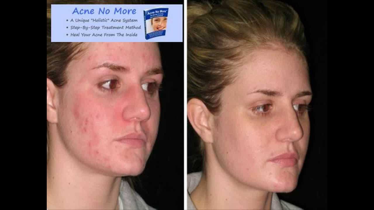 Homemade Acne Treatments That Work Fast - YouTube
