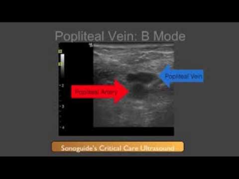 Basic Scanning Technique for Bedside DVT Ultrasound - YouTube