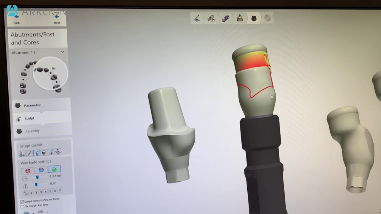 Custom locator abutments - YouTube