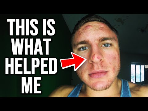 Can You Get Pimples On Nose From Stress