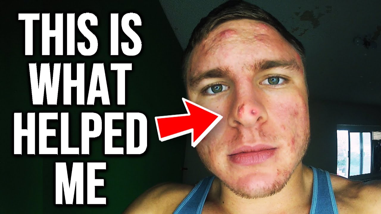 GET RID OF YOUR NOSE ACNE! (FROM EXPERIENCE) - YouTube