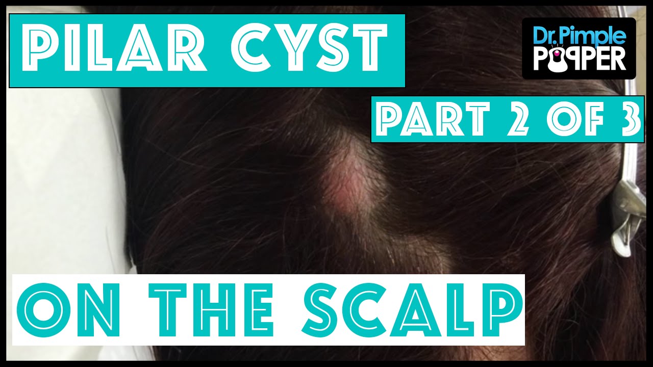 A Nice Pilar Cyst Her Second Of Three To Be Excised Youtube