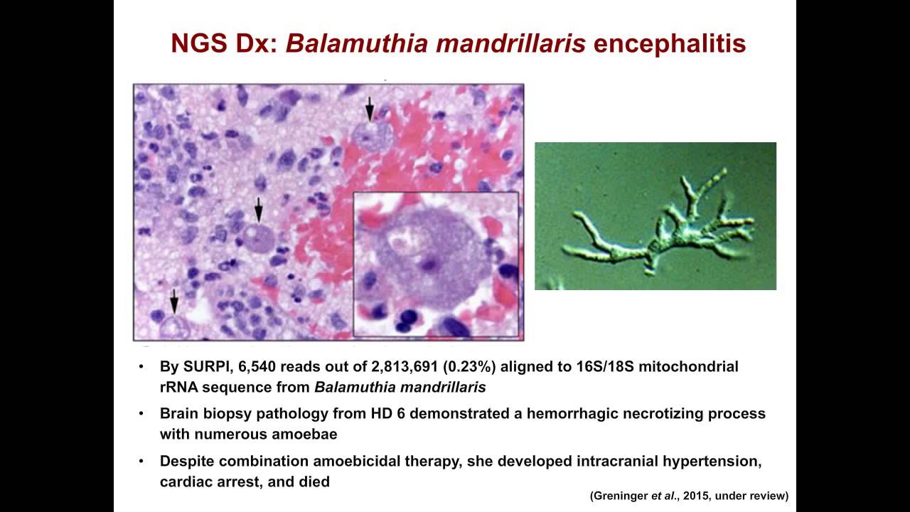 Charles Chiu - Next Generation Sequencing for Diagnosis and ...