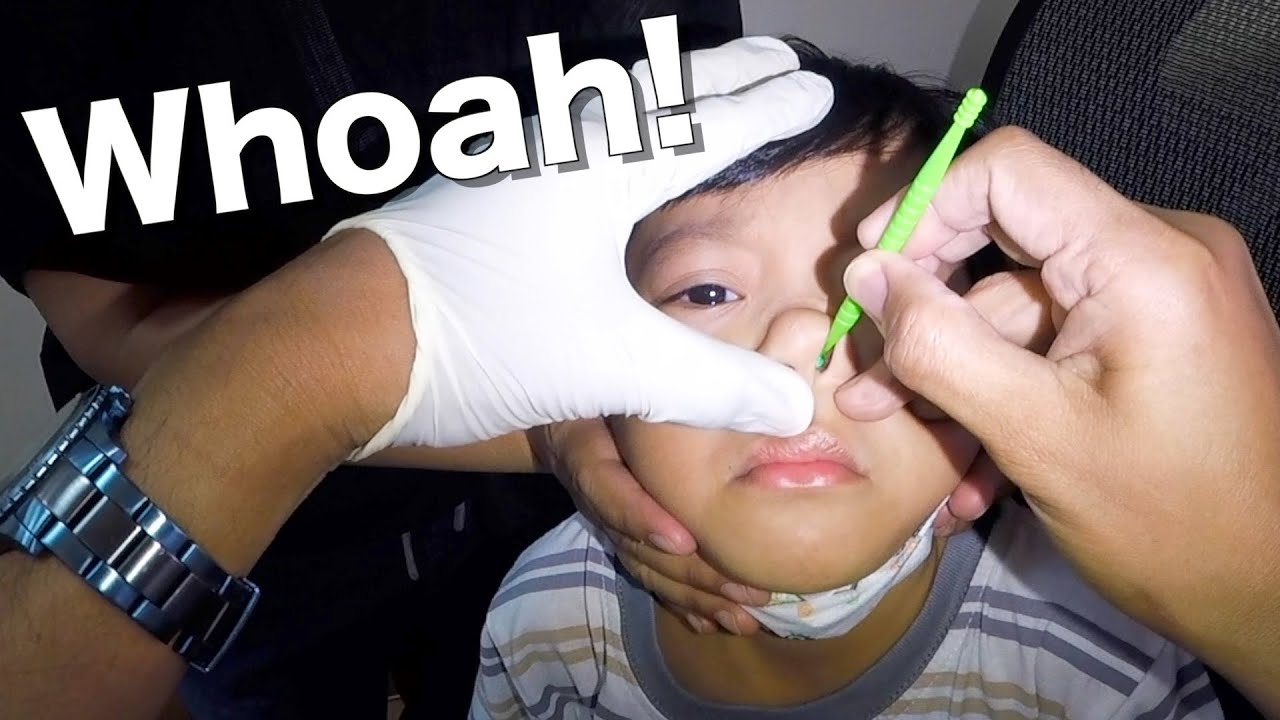 Something Green Stuck Inside Boy's Nose | What is it? - YouTube