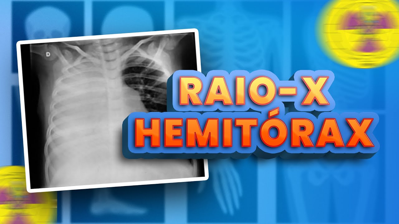 O QUE É RAIO-X POR HEMITÓRAX? | Radiologando - YouTube