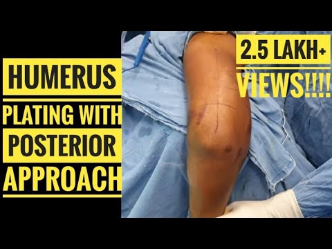 Humerus Plating with Posterior Approach (Detailed Step by Step Approach ...