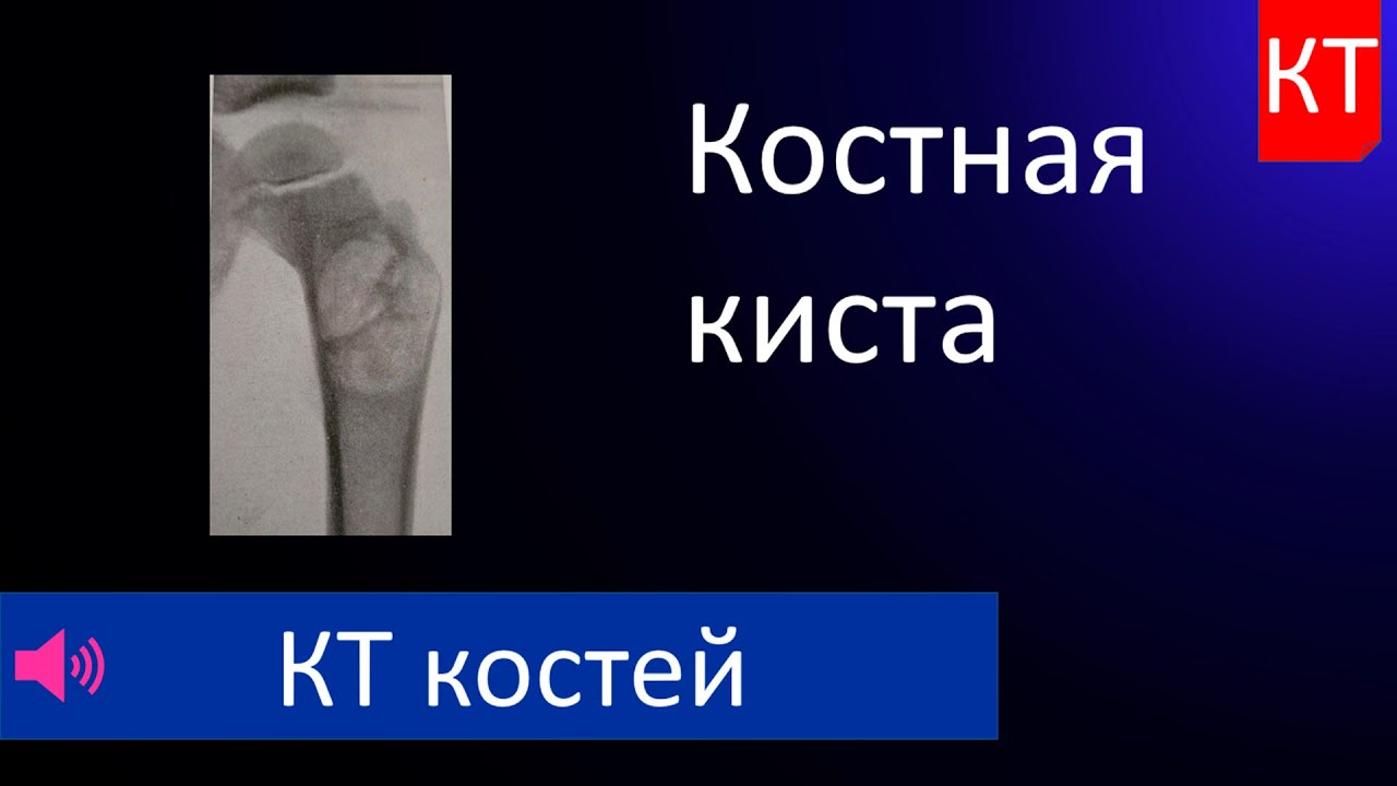 Лучевая диагностика костной кисты - YouTube