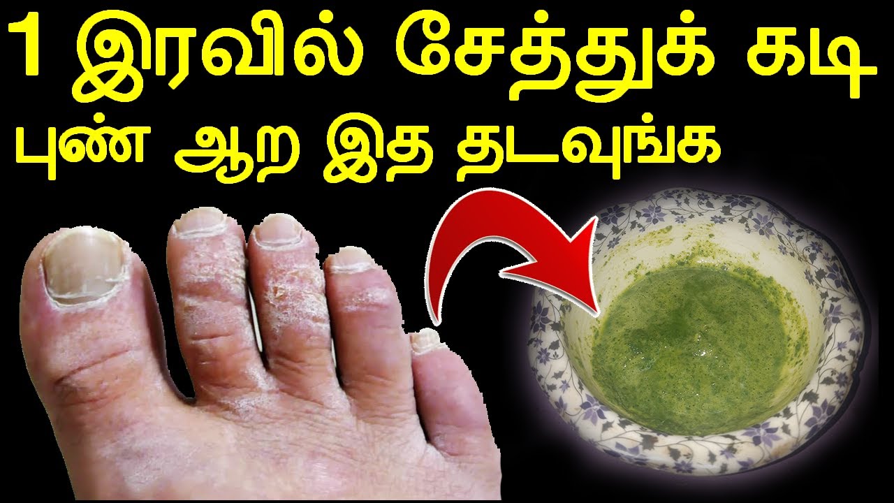 1 நிமிடம் 1 இரவு தடவினால் போதும் சேத்துக் கடி புண் ஆறும் | sethu kadi ...