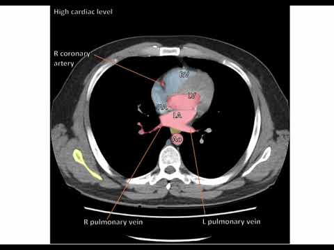 Anatomy of a Transverse CT of the Thorax -What the Radiologist should ...